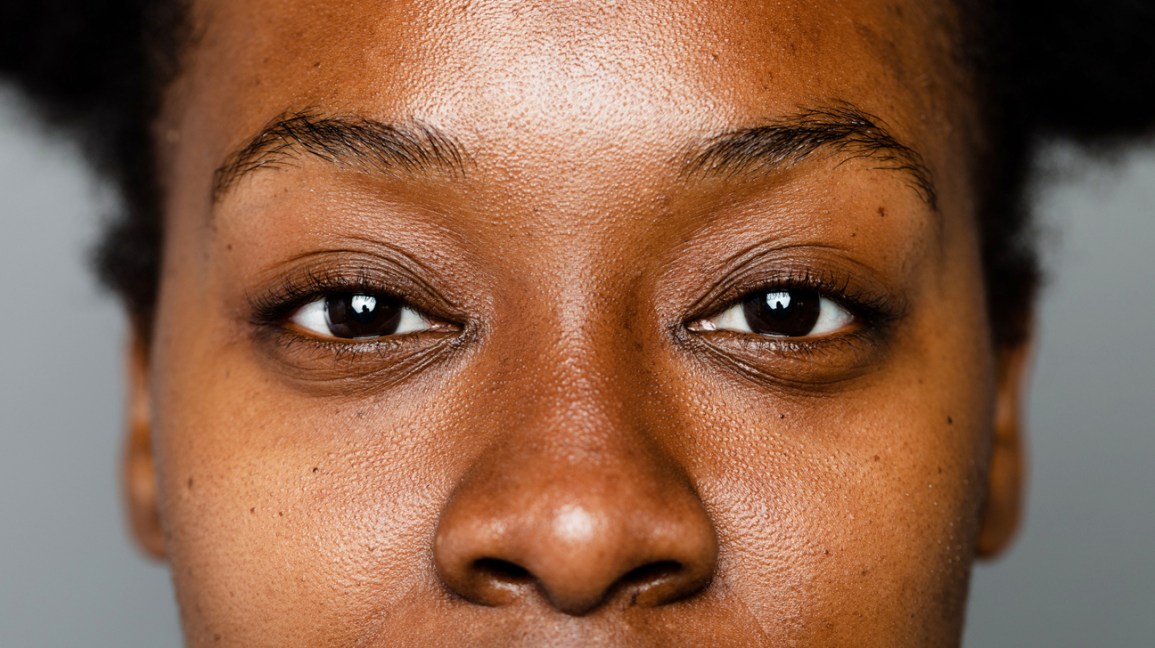 What is Hyperpigmentation and How to treat it – Facial Aesthetic Solutions